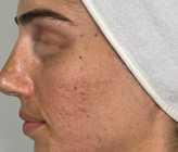 Reverso by INDIBA | Deep Fractional Radiofrequency for Skin Aging ...