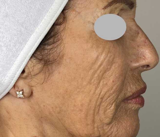 Reverso by INDIBA | Deep Fractional Radiofrequency for Skin Aging ...