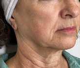 Reverso by INDIBA | Deep Fractional Radiofrequency for Skin Aging ...