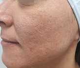 Reverso by INDIBA | Deep Fractional Radiofrequency for Skin Aging ...